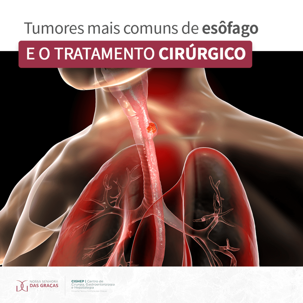 Tumores mais comuns de esôfago e o tratamento cirúrgico - Cighep
