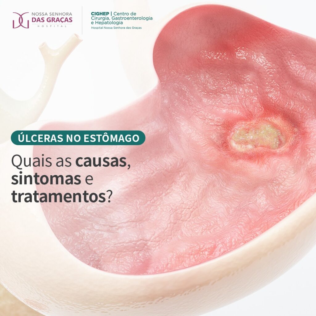 Úlceras no estômago | Quais as causas, sintomas e tratamento? - Cighep