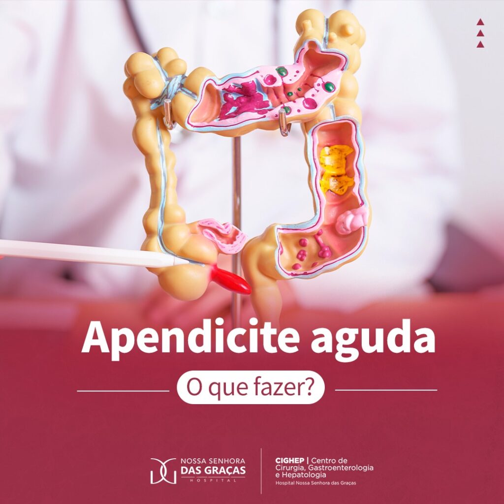 Apendicite aguda. O que fazer? - Cighep