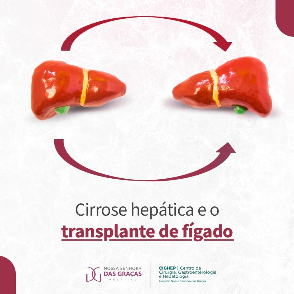 Cirrose hepática e o transplante de fígado - Cighep